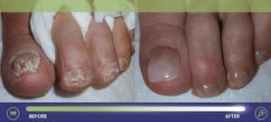 KeryFlex Nail Restoration - Entire Podiatry